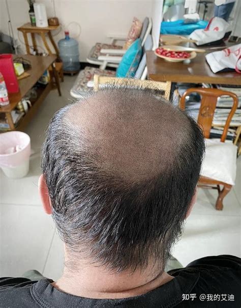纹发改善脱发引起的光亮头皮 知乎