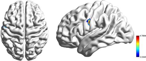 重度抑郁症患者额叶和顶叶在不同疾病未治疗持续时间内的功能和结构变化 European Archives Of Psychiatry And Clinical Neuroscience X Mol