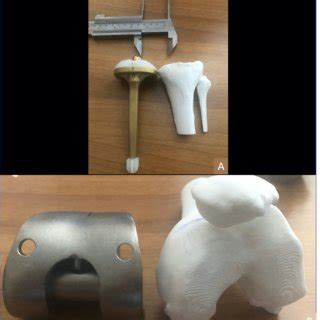 Three Dimensionally Printed Model For Pre Operative Planning And
