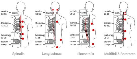 Deep Spinal Muscle Trigger Points And Referred Pain Stock Illustration