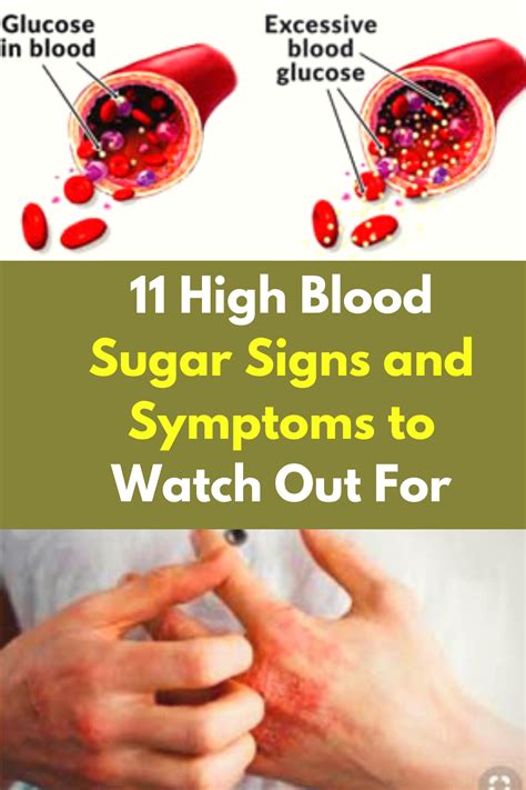 High Blood Sugar Signs And Symptoms To Watch Out For