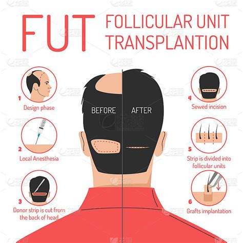 Fut与fue毛发移植过程分离