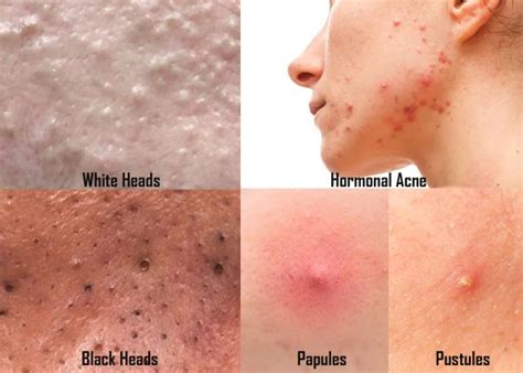 Different Types Of Acne And Effective Treatments Meds For Less