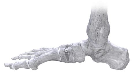 Additive Orthopaedics® Cotton Plantarflexing Osteotomy Wedge Paragon 28