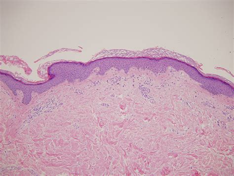 Lichen Amyloidosis Dermatopathology