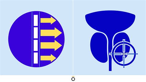 Halo Diagnostics Expands Radiation Free Minimally Invasive Prostate