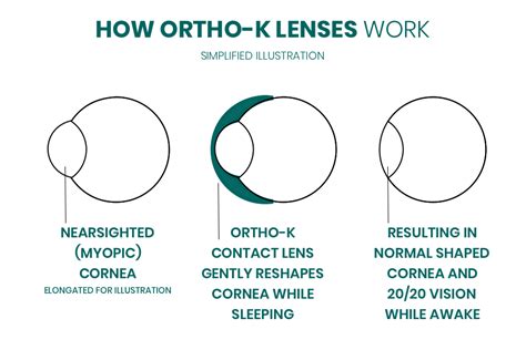 Ortho K Contact Lenses In Oklahoma Bespoke Vision