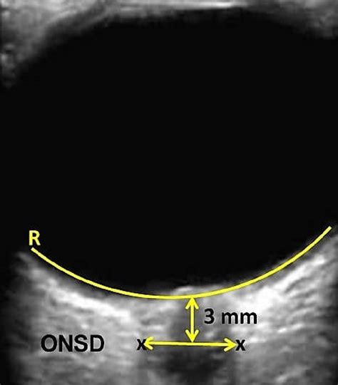 Optic Nerve Sheath Ultrasound Measures Download Scientific Diagram