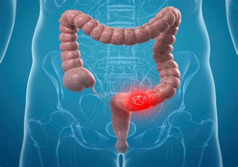 Cáncer Según Harvard La Enfermedad Silenciosa Sigue Afectando A Los