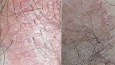 Inverse Psoriasis Photos Pictures Of Groin Armpit