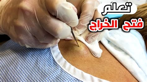 اتعلم فتح الخراج في المنزل او المستشفيlearn The Correct Way To Open An