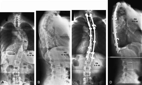 Adult Scoliosis Surgical Indications Operative Management Spine