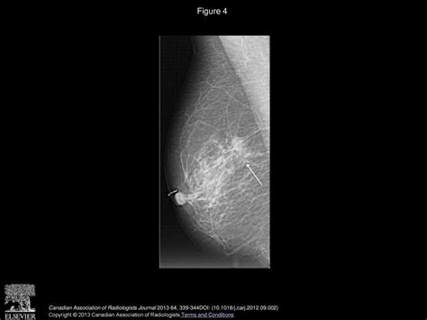 Low Grade Adenosquamous Carcinoma Of The Breast Imaging And