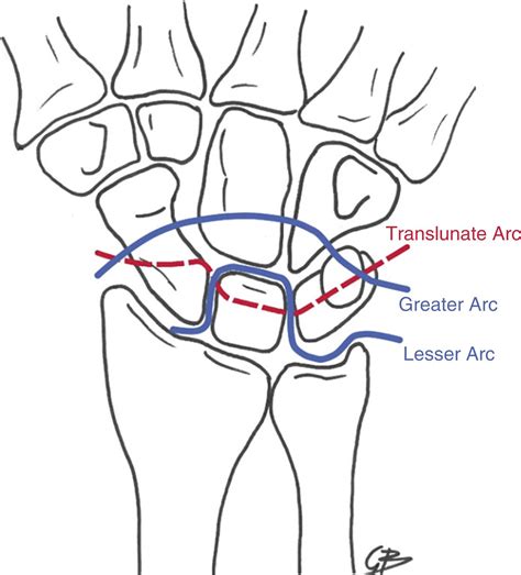 Perilunate And Lunate Dislocations Clinical Tree