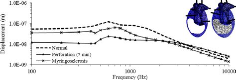 Figure 16 From Analysis Of Eardrum Pathologies Using The Finite Element Method Semantic Scholar