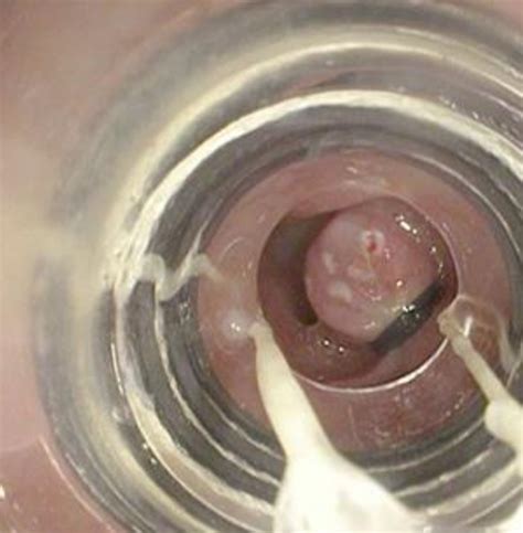 食管癌图片有来医生