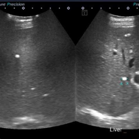 Ultrasonographic Image Of The Liver Showing Multiple Calcified Nodules
