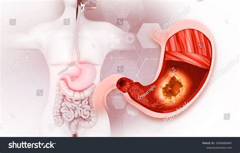 Stomach Cancer Gastric Cancer Symptoms Stages Stock Illustration