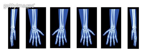 Set Of X Ray Hands With Radius Ulna Skeleton Human Body Bones Adult