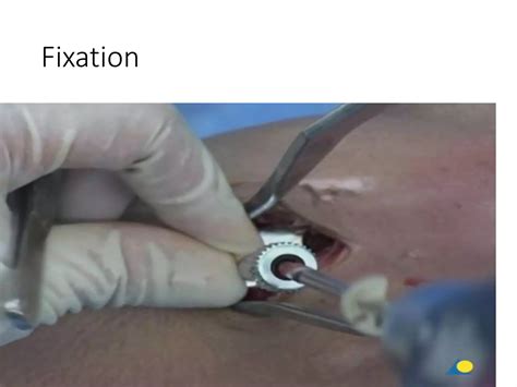 Treatment Of Segmental Femoral Fracture Pptx