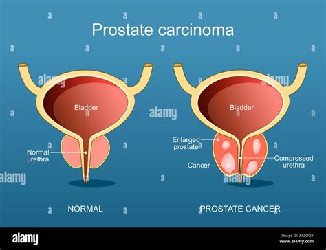 Prostate Cancer Adenocarcinoma Cross Section Of A Human Bladder And Prostate Gland Disorder