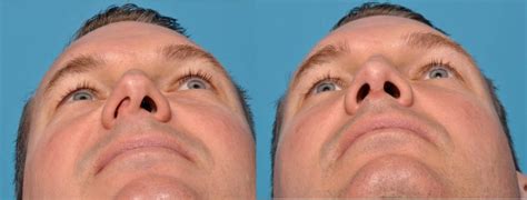 Deviated Septum Causes Symptoms And Treatment