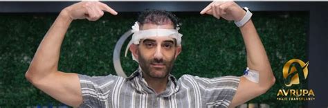 No Shave Fue Hair Transplant Benefits Risks And Process