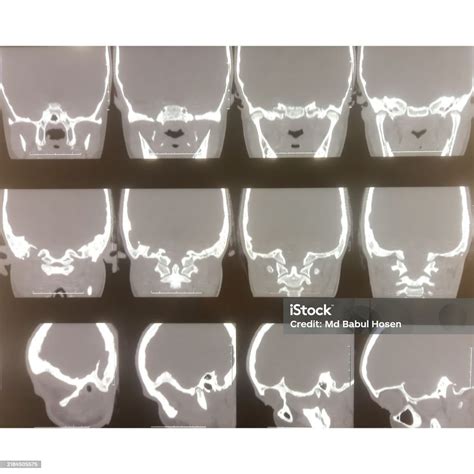 Ct Scan Of The Temporal Bones Showing Soft Tissue Density Lesion At Bilateral Middle Ear And