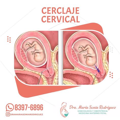 Cerclaje Cervical 🩺es Dra María Sonia Rodríguez