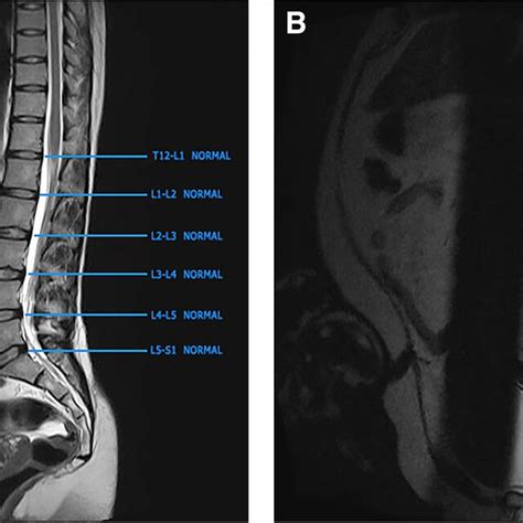 A Normal Lumbar Mri B Disc Desiccated And Bulged Mri Color Figure