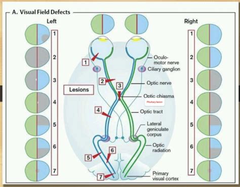 Lecture 6b Visual Field Testing Flashcards Quizlet