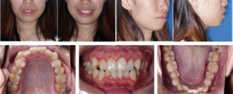 龅牙妹变身大美女