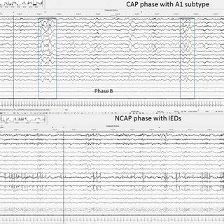 Examples Of A Normal Cyclic Alternating Pattern Cap Phase With