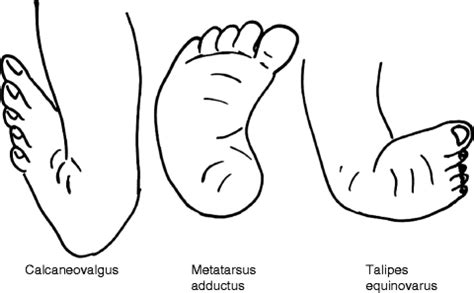 Metatarsus Adductus Vs Clubfoot