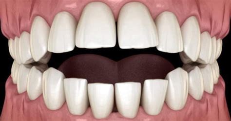 Pasang Behel Gigi Jika Anda Mengalami 1 Dari 5 Hal Ini