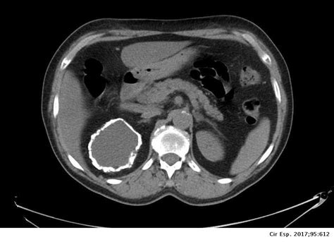 Calcified Adrenal Pseudocyst A Rare Pathology Cirugía Española