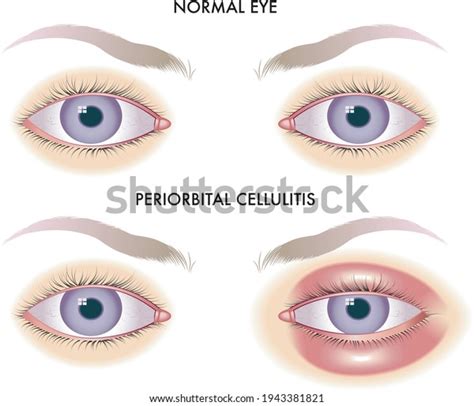 1 Orbital Cellulitis Stock Vectors And Vector Art Shutterstock