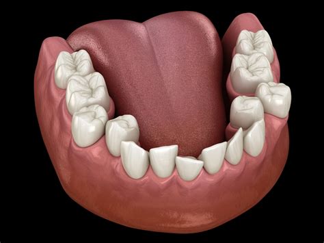 Why Are Crowded Teeth A Problem