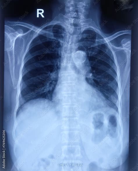 Pneumonitis Right Cxr Chest X Ray Pa View Hypersensitivity