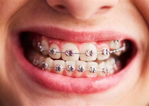 Know The Dangers Of Fake Braces Somos Dental