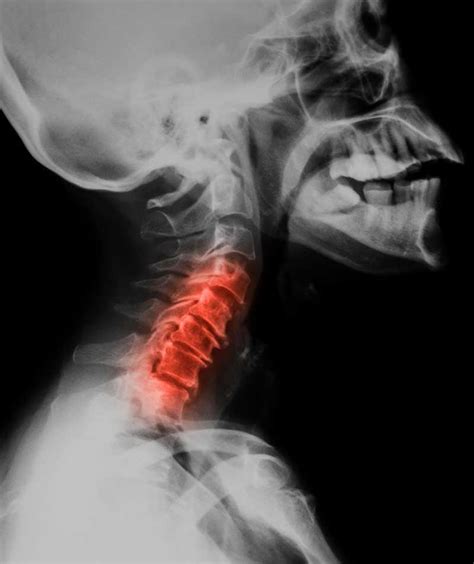 ساییدگی مهره‌های گردن دلایل، علائم و روش‌های درمان دکتر محمد صمدیان