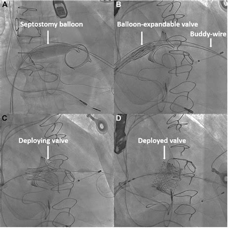 A Modified Buddy Wire Technique For Crossing Of The Interatrial Septum