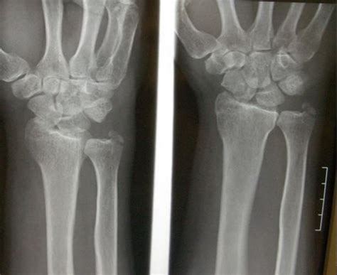 Compound Fractures X Ray