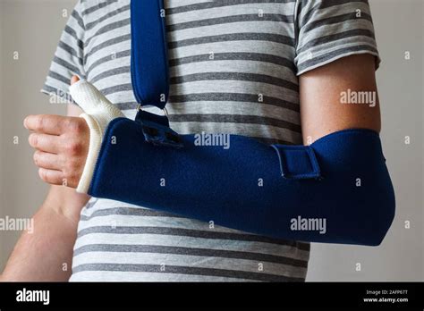 Homme Avec Plâtre Sur Le Pouce Cassé Fracture Du Poignet Fracture De