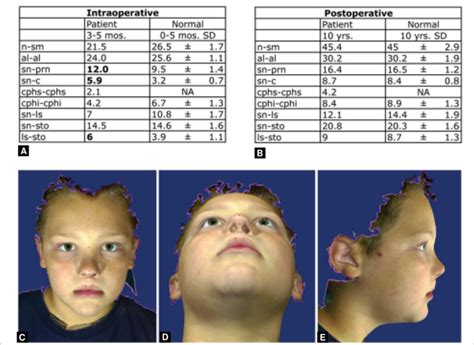 A Direct Anthropometry Of Patient In Figure 11 Compared To Normal