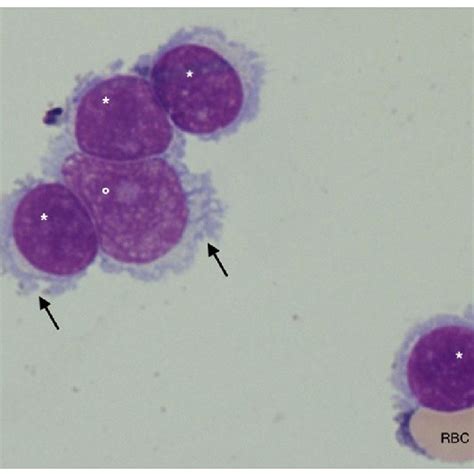 Csf Microscopy Showing One Medium ° And Four Smallsized Lymphoid