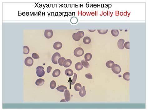 B12 фолийн хүчлийн дутагдлын анеми Ppt Ppt