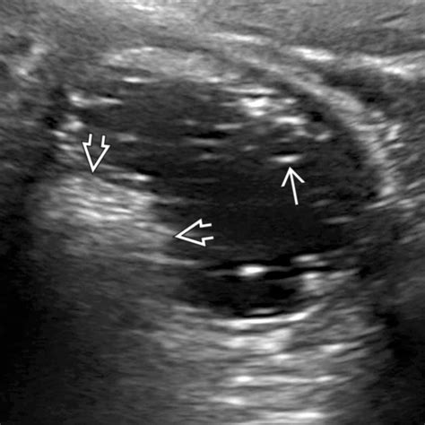 Ovarian Teratoma Radiology Key