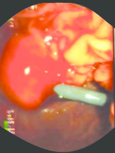 Photograph Of The Ercp Showing A Stent Placed In The Bulging Ampulla Download Scientific Diagram