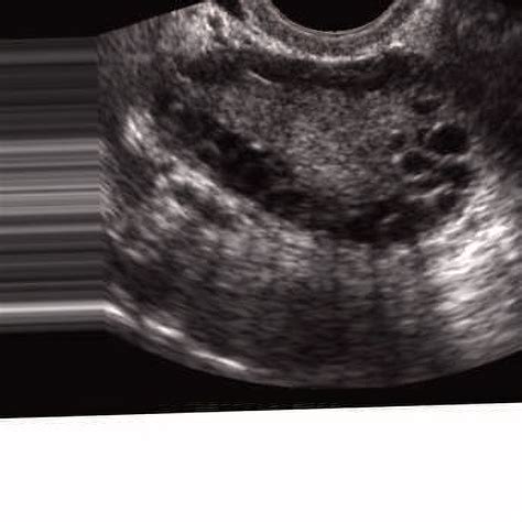 pcos pcos gsgip roboflow universe